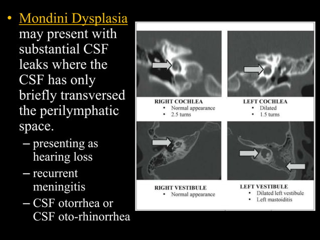Cerebrospinal fluid rhinorrhea (CSF) | PPTX | Death, Injury, or ...