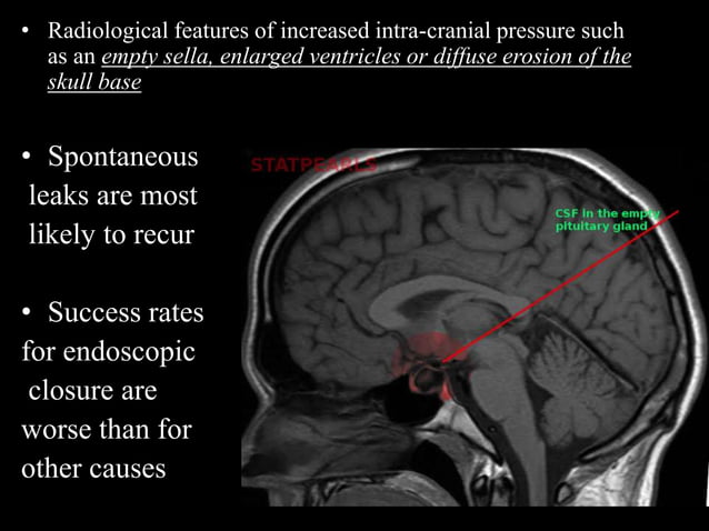 Cerebrospinal fluid rhinorrhea (CSF) | PPTX | Death, Injury, or ...