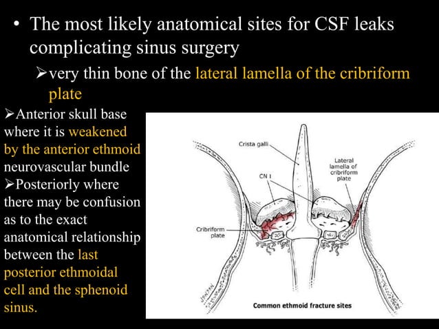Cerebrospinal fluid rhinorrhea (CSF) | PPTX | Death, Injury, or ...