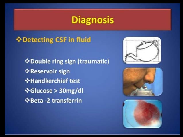 Cerebrospinal fluid rhinorrhea (CSF) | PPTX | Death, Injury, or ...