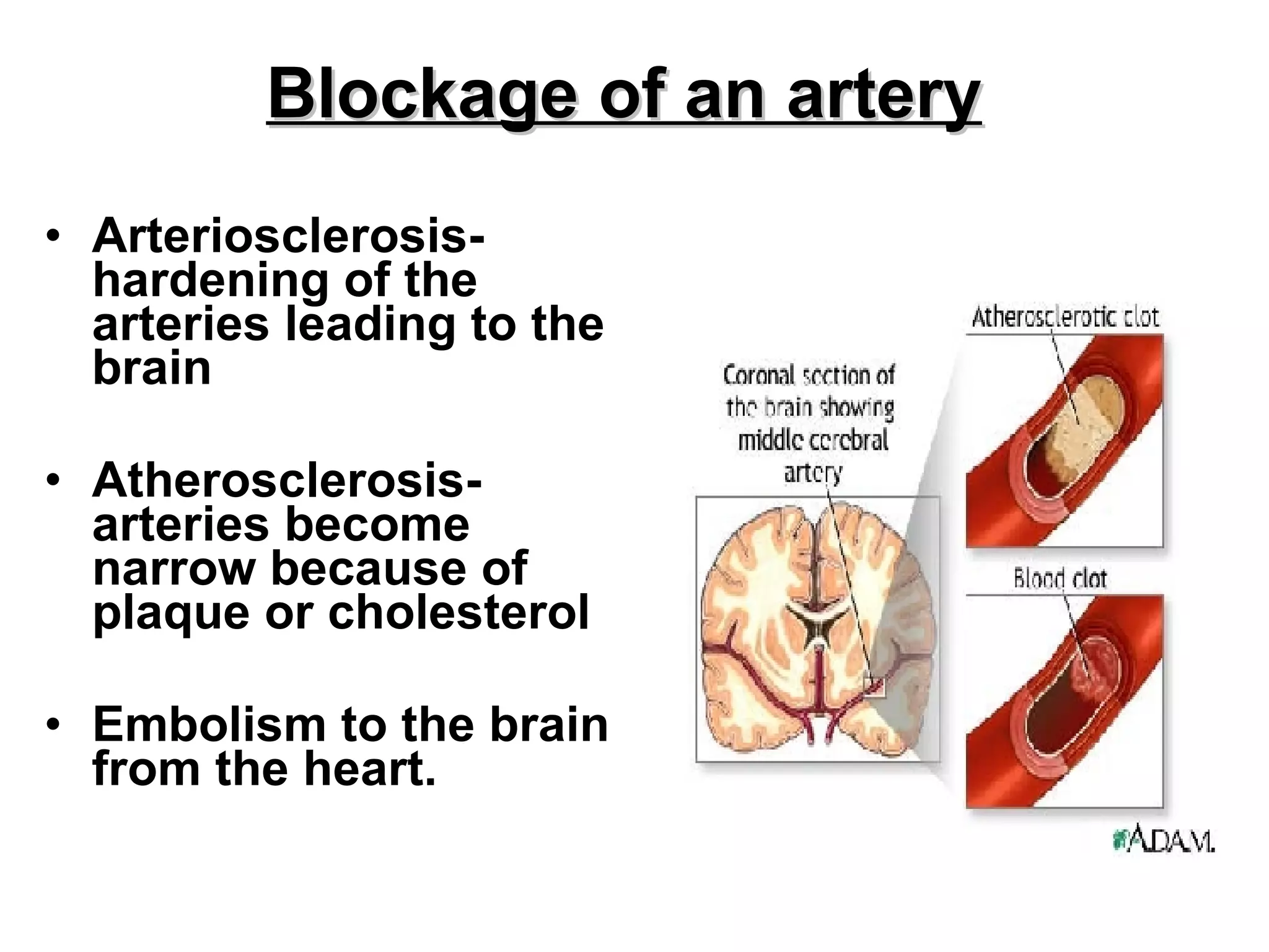 Cerebrovascular Accident (CVA) | PPT