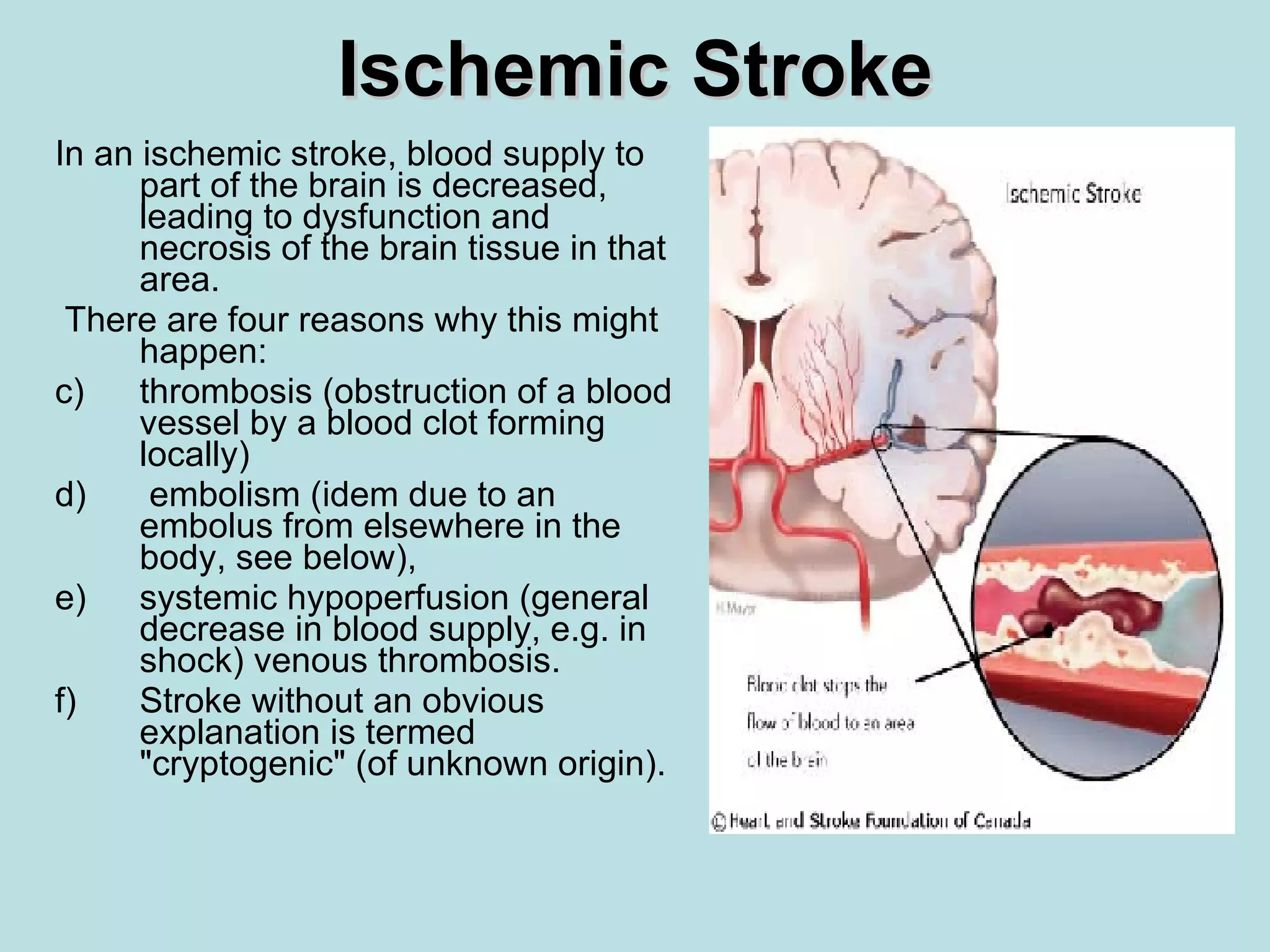 Cerebrovascular Accident (CVA) | PPT