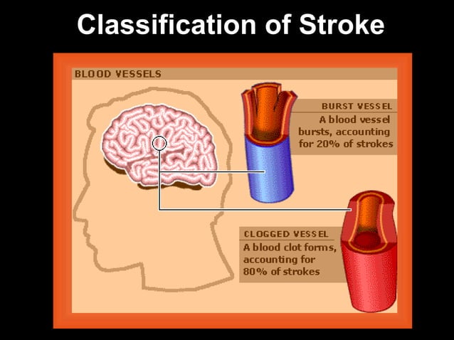 Cerebrovascular Accident (CVA) | PPT