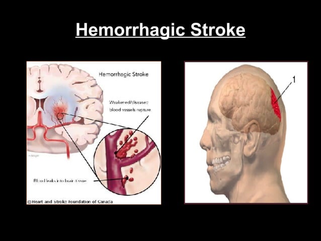 Cerebrovascular Accident (CVA) | PPT