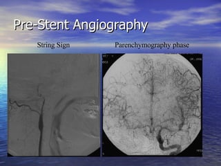 Cerebrovascular disease (CVA / Stroke) | PPT