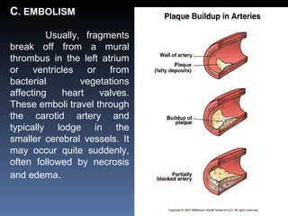 Cerebrovascular Acc Dr.T | PPT