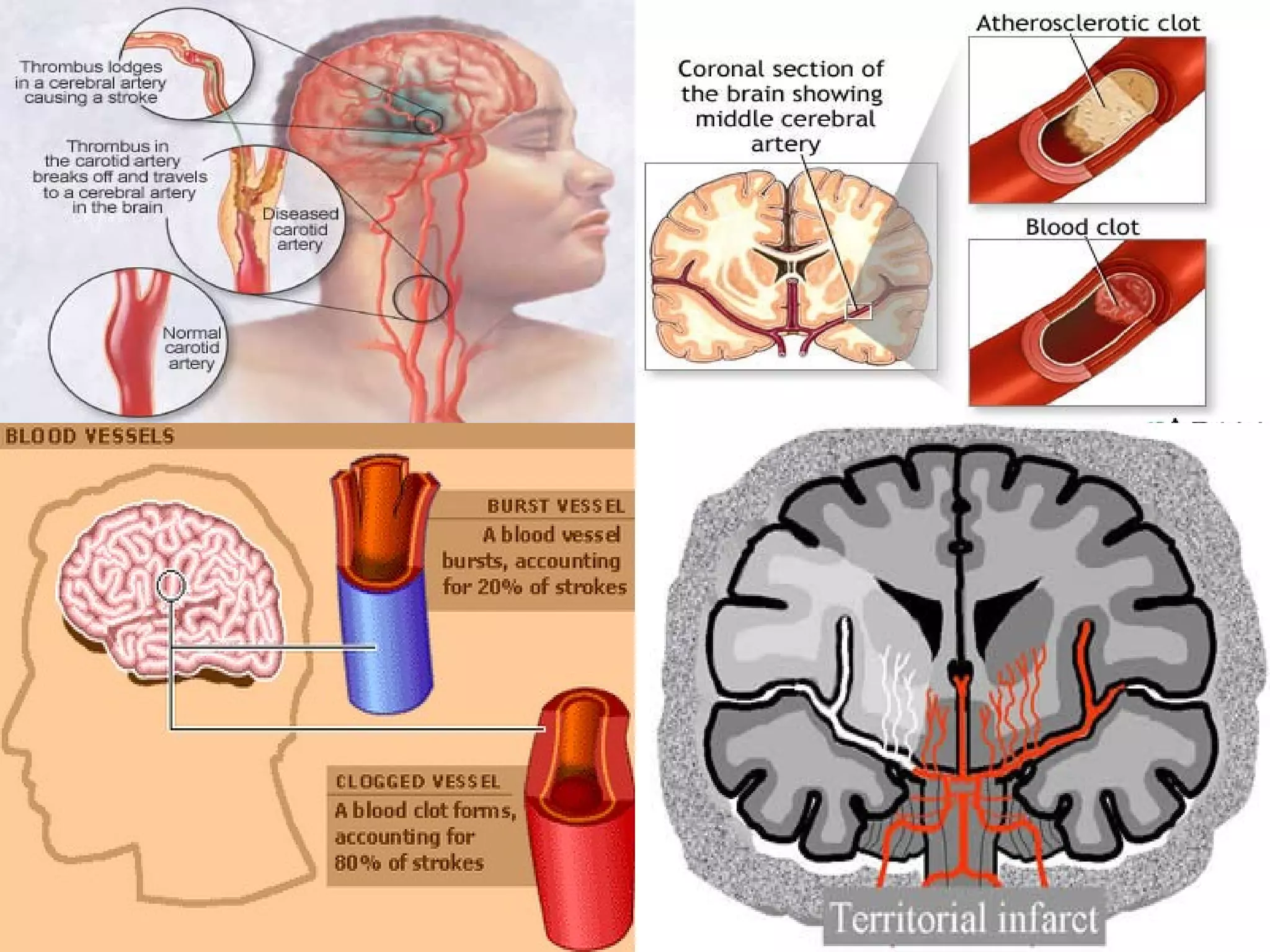 Cerebro vascular accident | PPT
