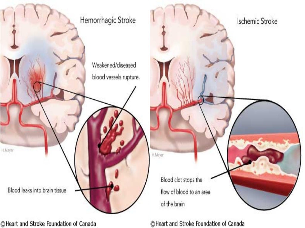 Cerebro vascular accident
