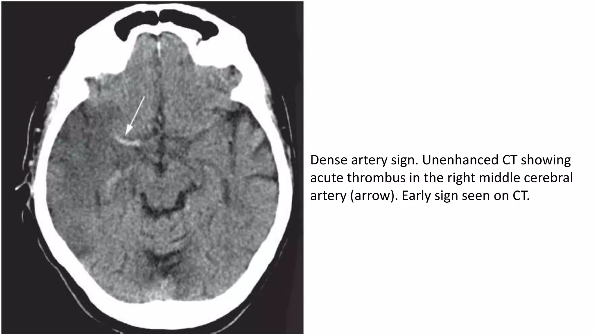 Cerebrovascular accident(CT and MRI changes) | PPTX