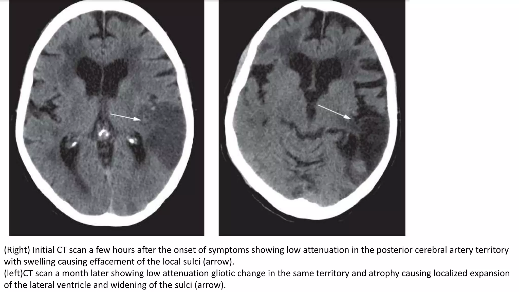 Cerebrovascular accident(CT and MRI changes) | PPTX
