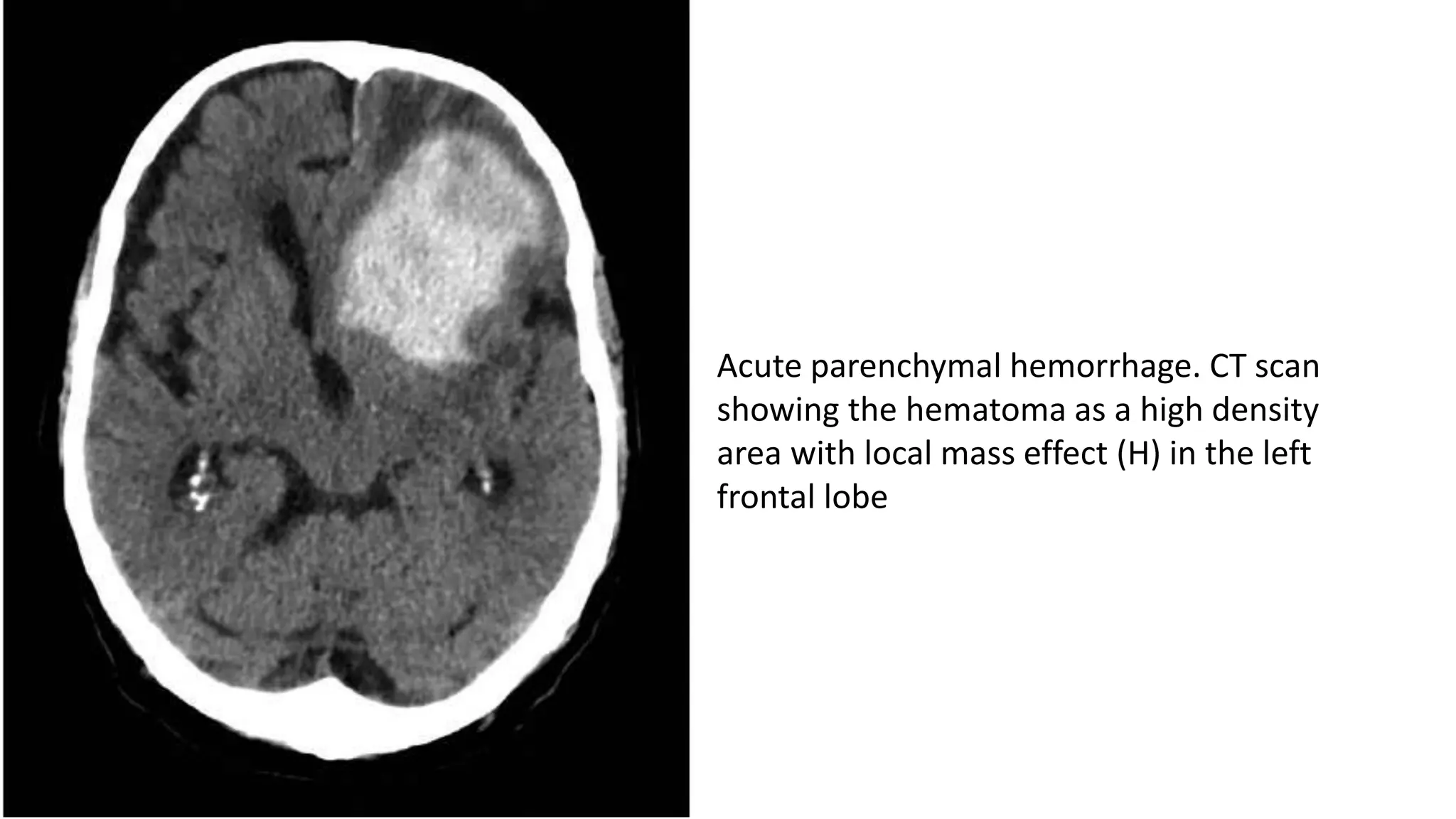 Cerebrovascular accident(CT and MRI changes) | PPTX