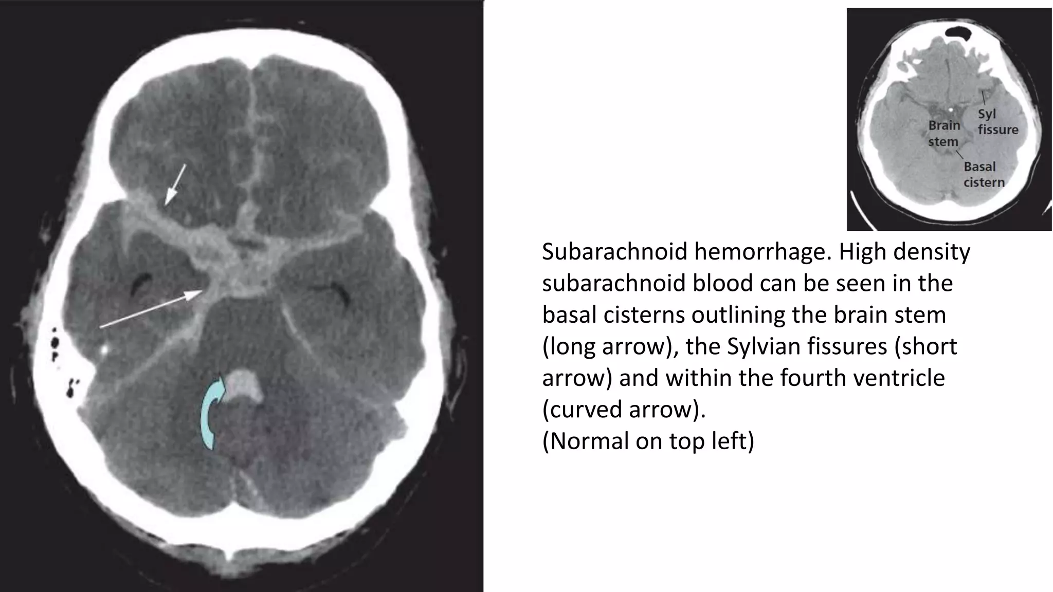 Cerebrovascular accident(CT and MRI changes) | PPTX
