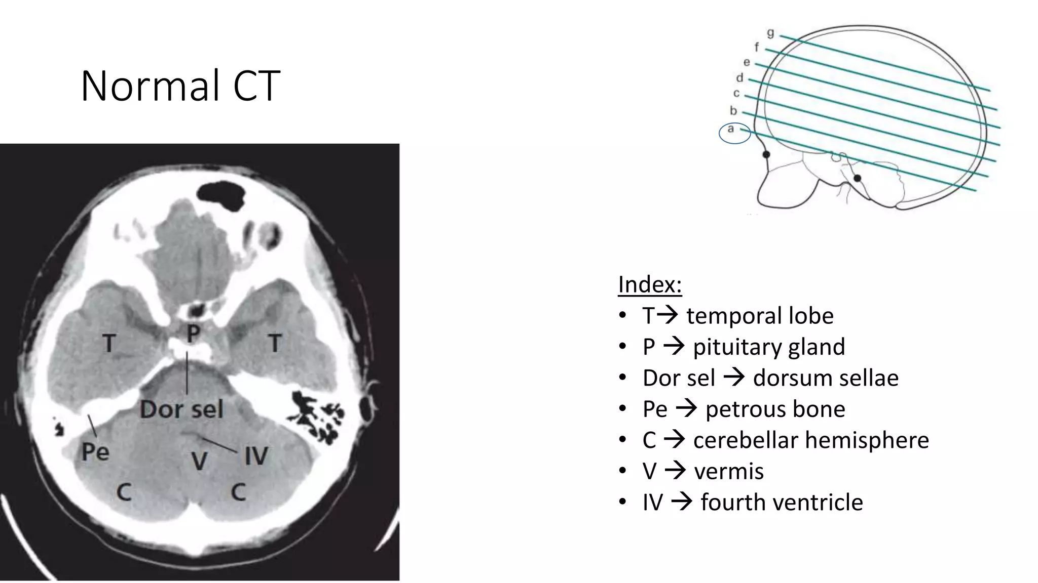 Cerebrovascular accident(CT and MRI changes) | PPTX