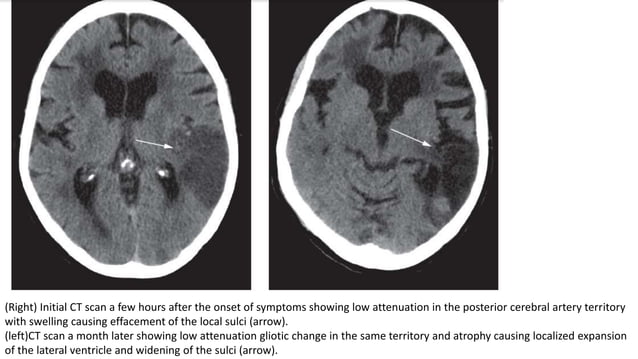 Cerebrovascular accident(CT and MRI changes) | PPTX
