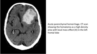 Cerebrovascular accident(CT and MRI changes) | PPTX