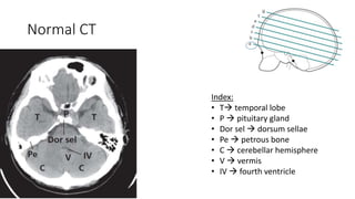 Cerebrovascular accident(CT and MRI changes) | PPTX