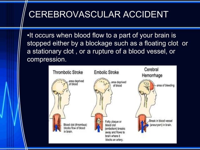 Cerebrovascular accident | PPTX