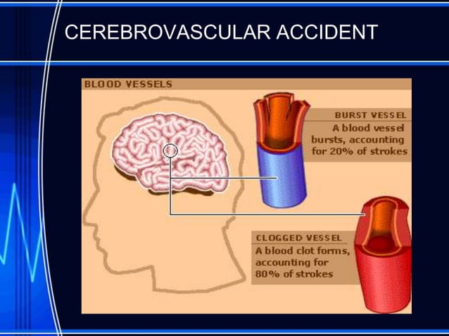 Cerebrovascular accident | PPTX
