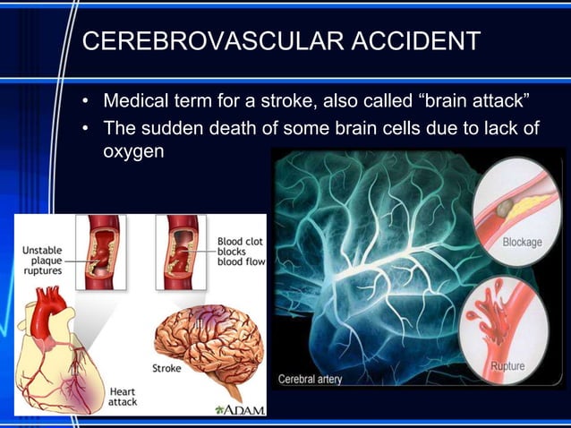 Cerebrovascular accident | PPT