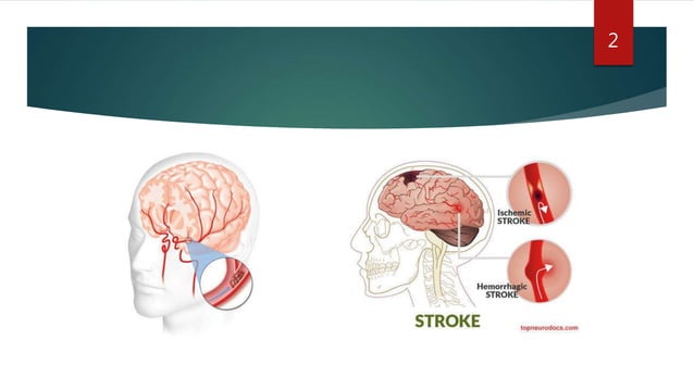 Case presentation on Cerebrovascular accident (Stroke) | PPTX | Brain and Nervous System ...