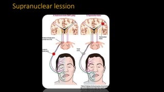 Cerebrovascular accident | PPT