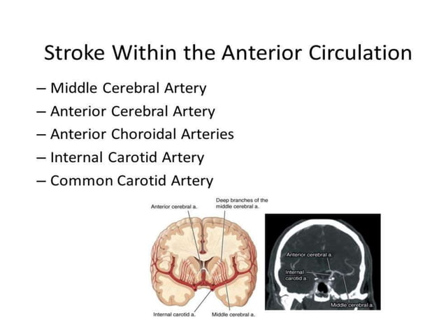 Localisation of stroke | PPTX