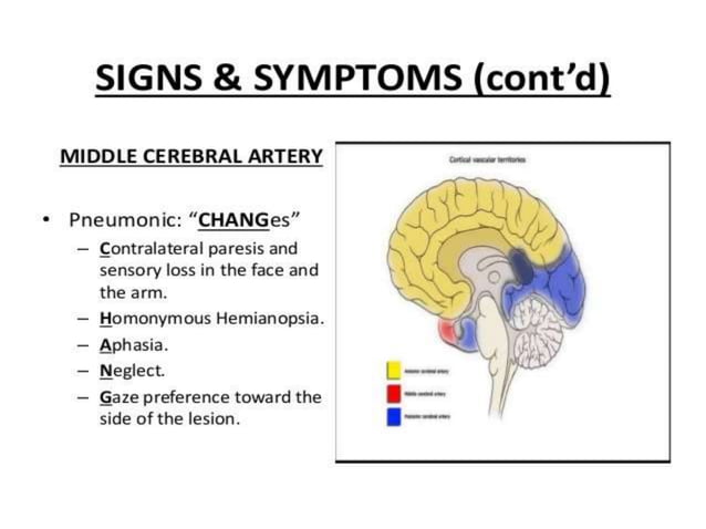 Localisation of stroke | PPTX