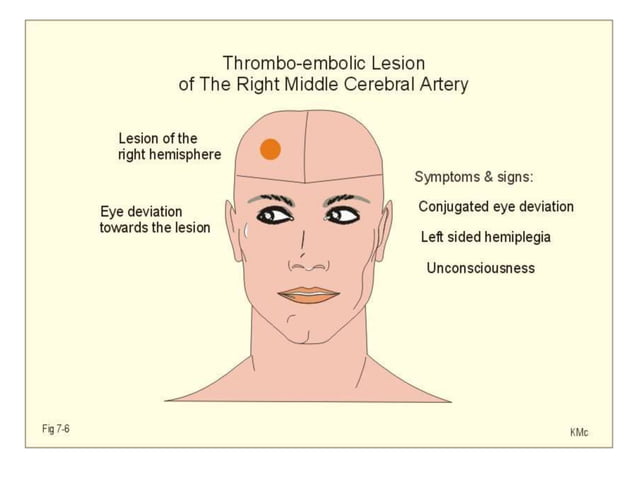 Localisation of stroke | PPTX