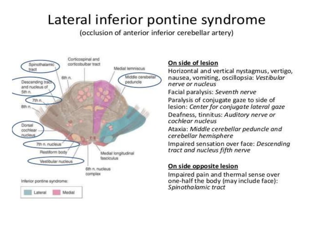 Localisation of stroke | PPTX