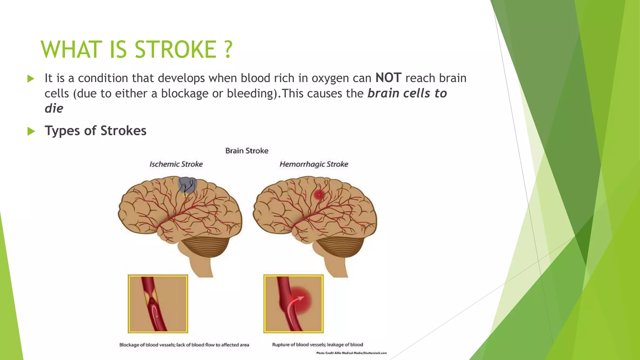 Cerebrovascular accident(cva) stroke | PPTX