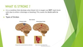 Cerebrovascular accident(cva) stroke | PPTX