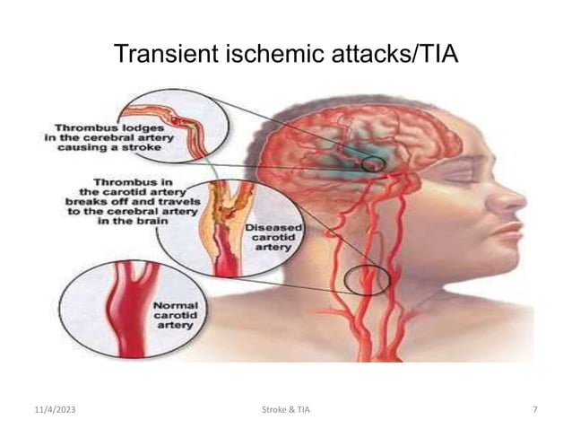 Cerebrovascular Accident &TIA.pptx