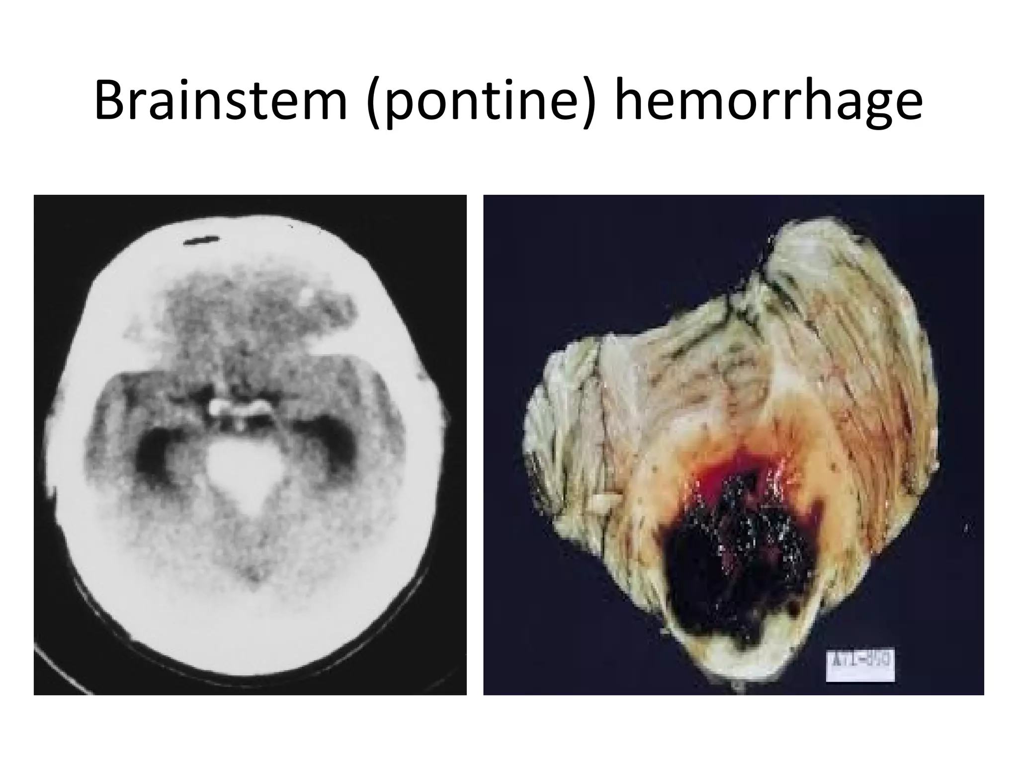 Cerebrovascular Disease Pathology Stroke Ppt