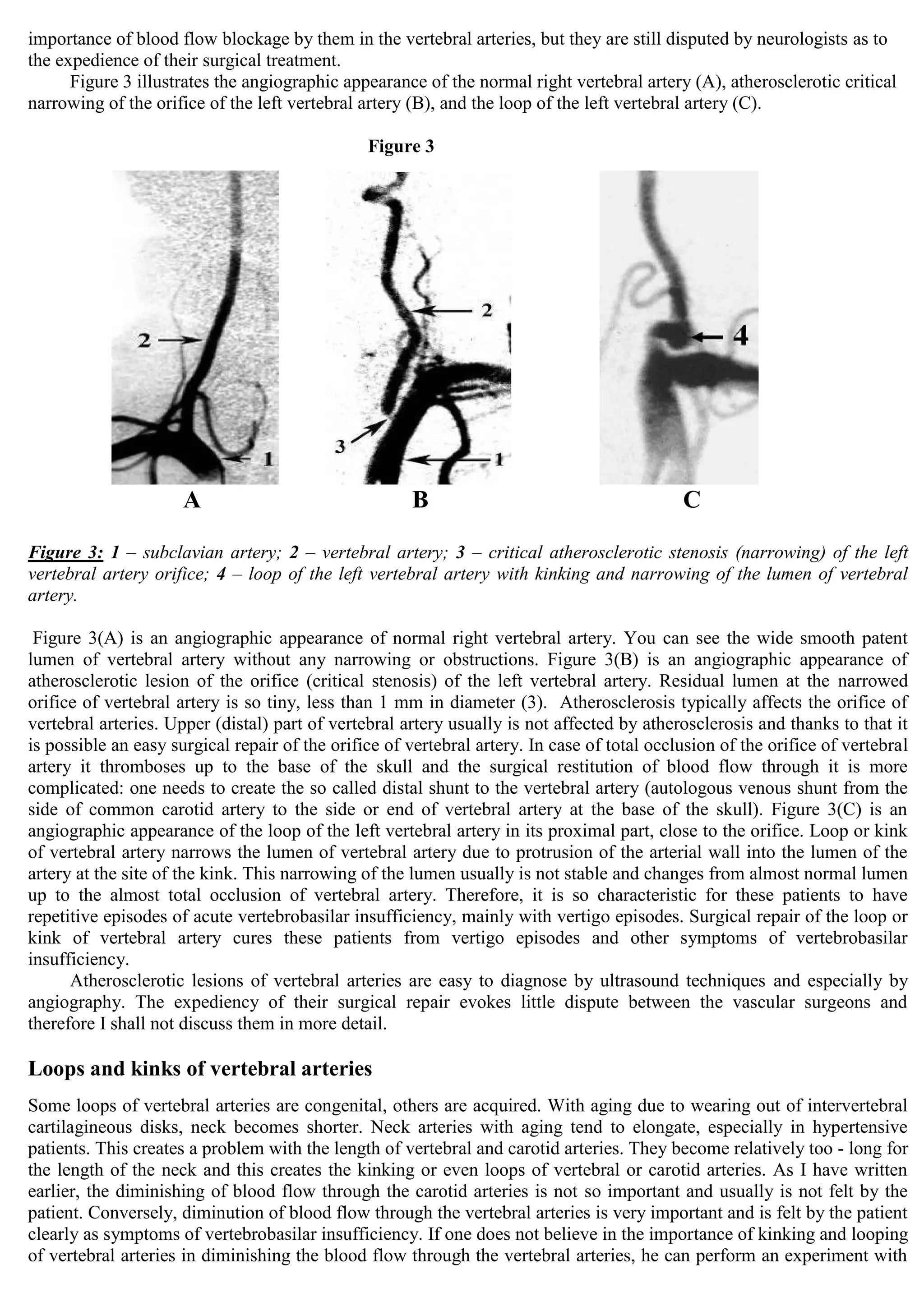 Cerebrovascular Disease, Cerebrovascular Insufficiency, Vertebrobasilar ...