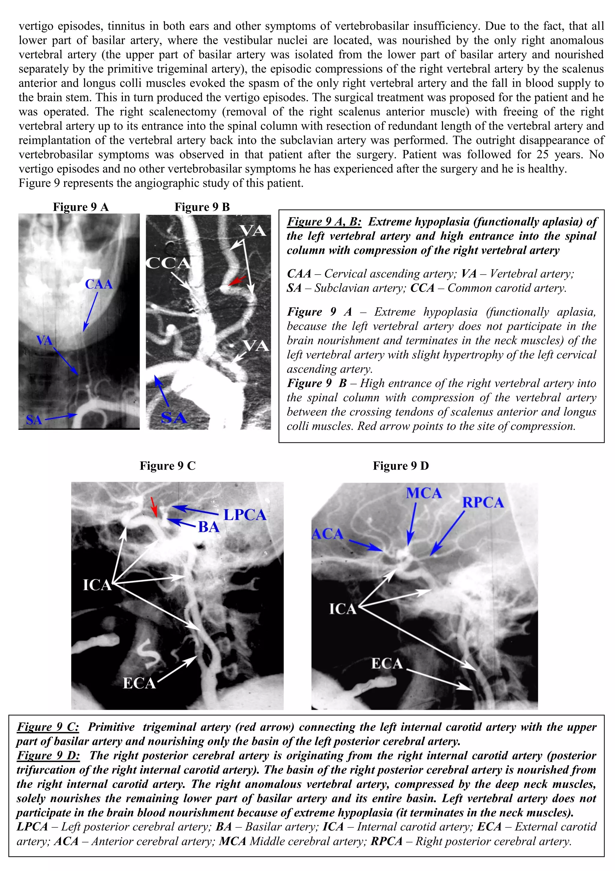 Cerebrovascular Disease, Cerebrovascular Insufficiency, Vertebrobasilar ...