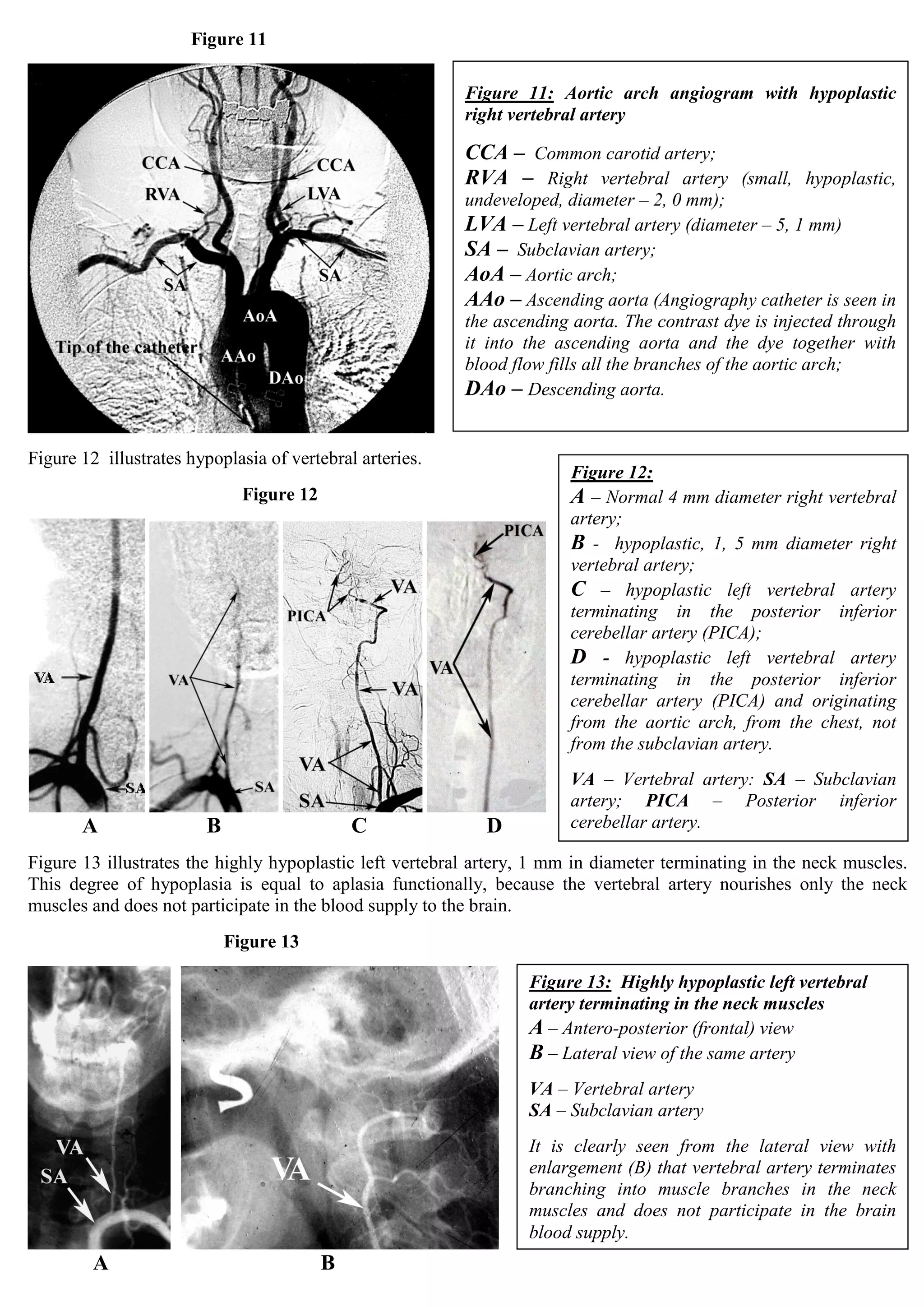Cerebrovascular Disease, Cerebrovascular Insufficiency, Vertebrobasilar ...