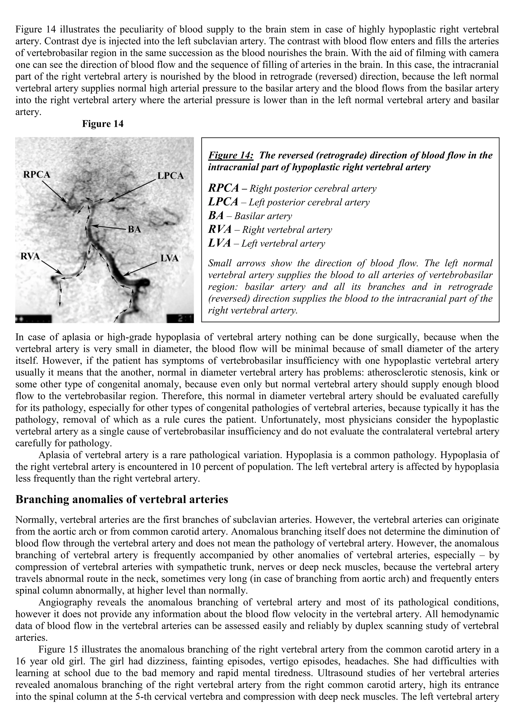 Cerebrovascular Disease, Cerebrovascular Insufficiency, Vertebrobasilar ...