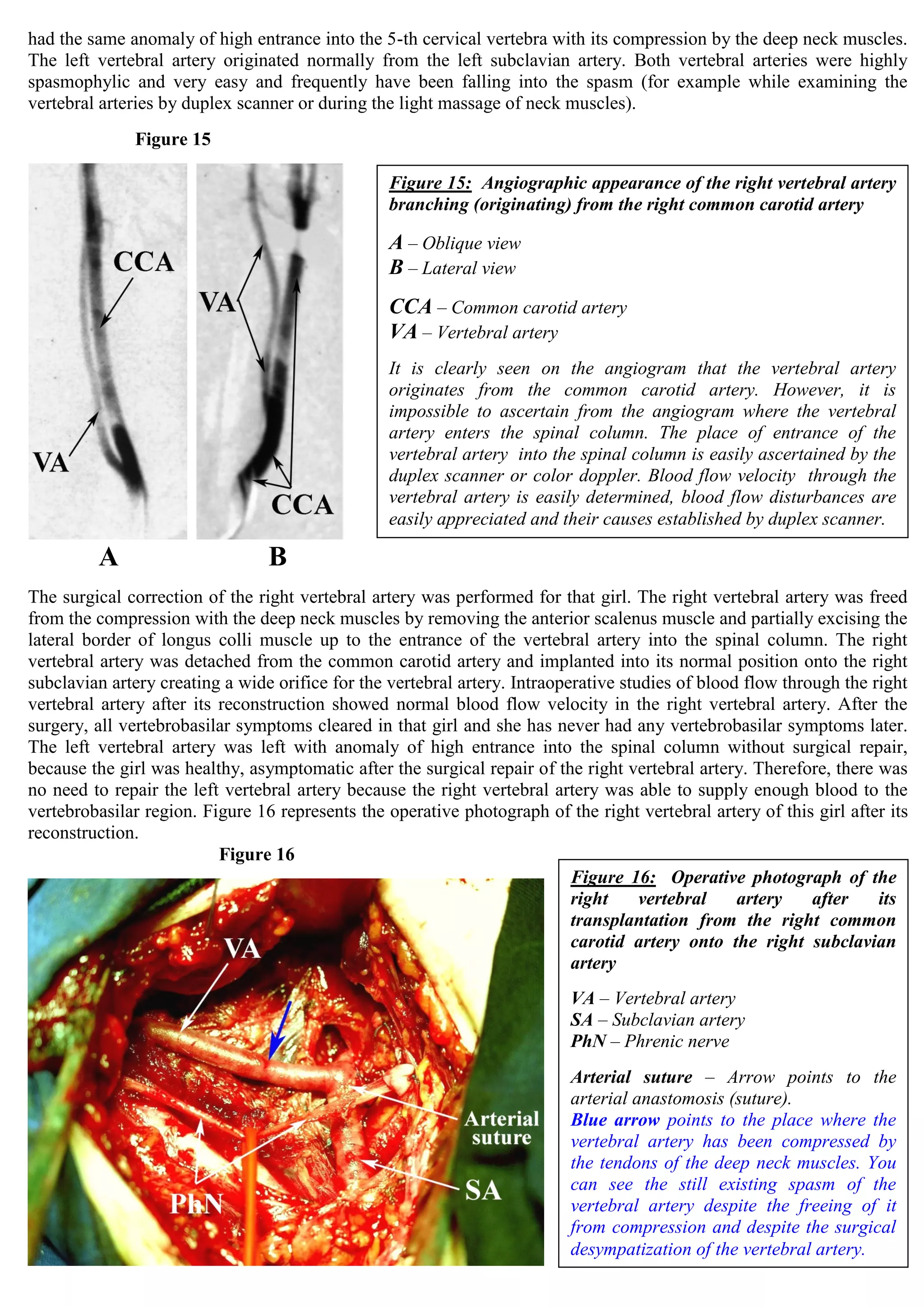 Cerebrovascular Disease, Cerebrovascular Insufficiency, Vertebrobasilar ...