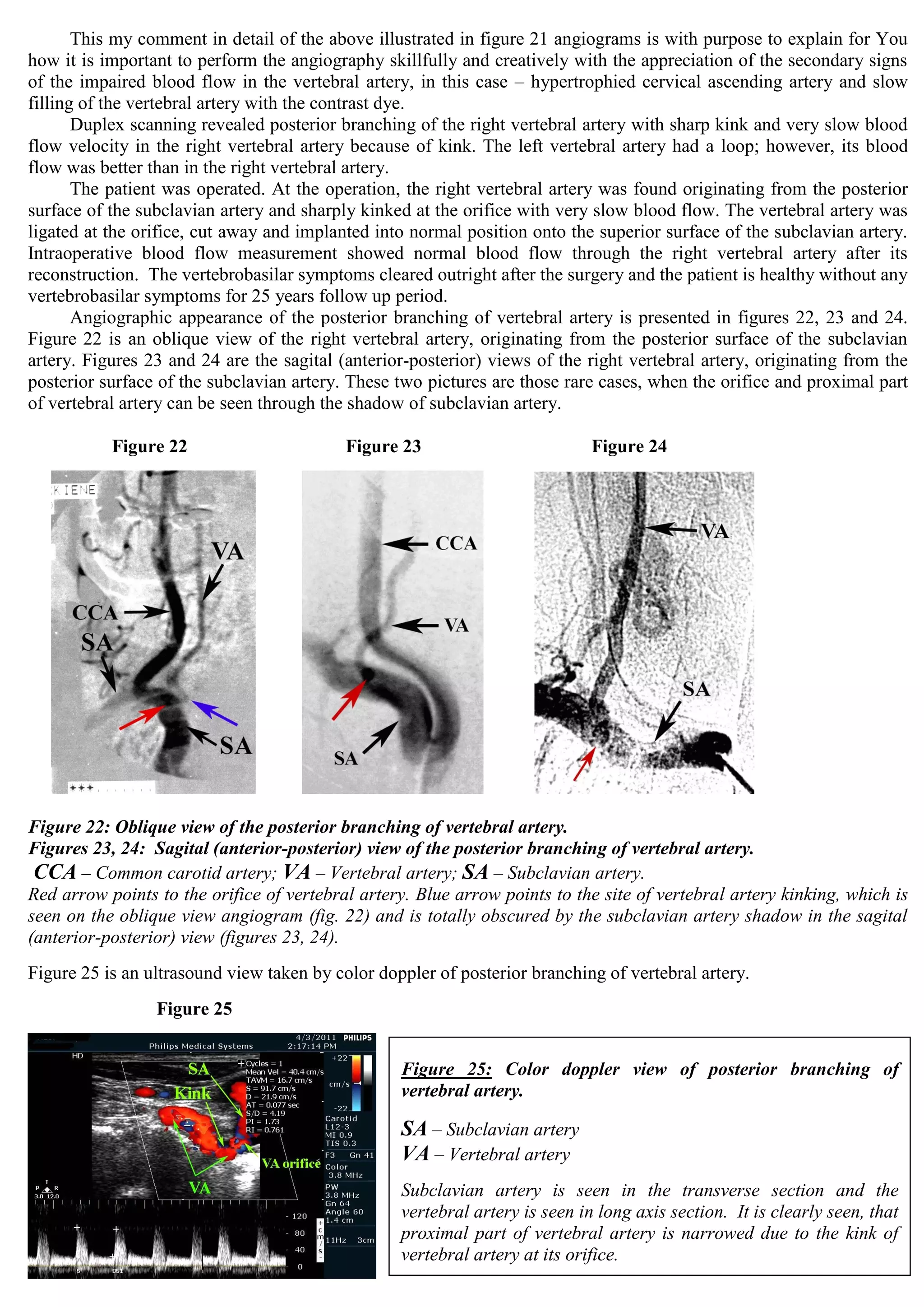 Cerebrovascular Disease, Cerebrovascular Insufficiency, Vertebrobasilar ...