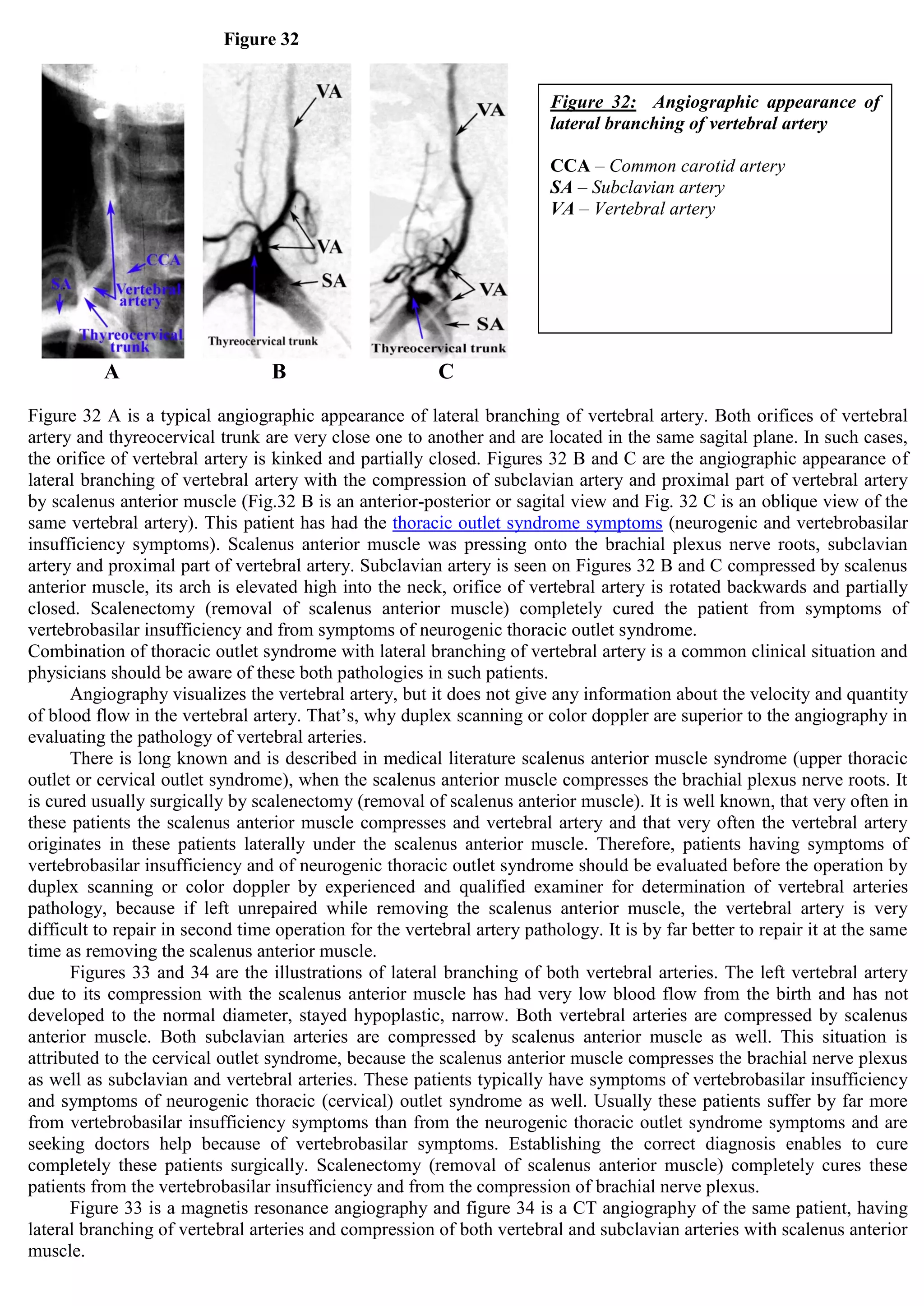 Cerebrovascular Disease, Cerebrovascular Insufficiency, Vertebrobasilar ...