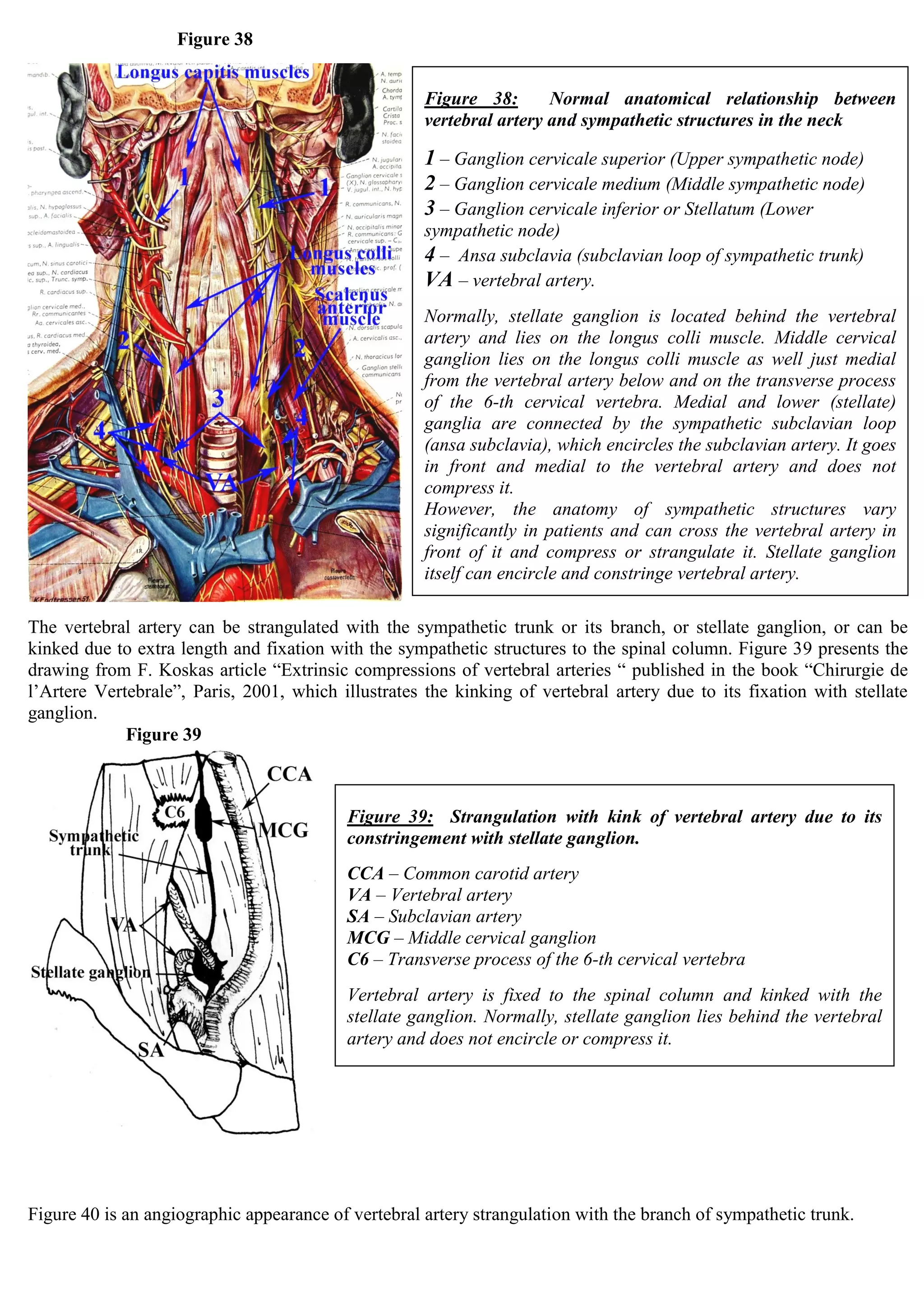 Cerebrovascular Disease, Cerebrovascular Insufficiency, Vertebrobasilar ...