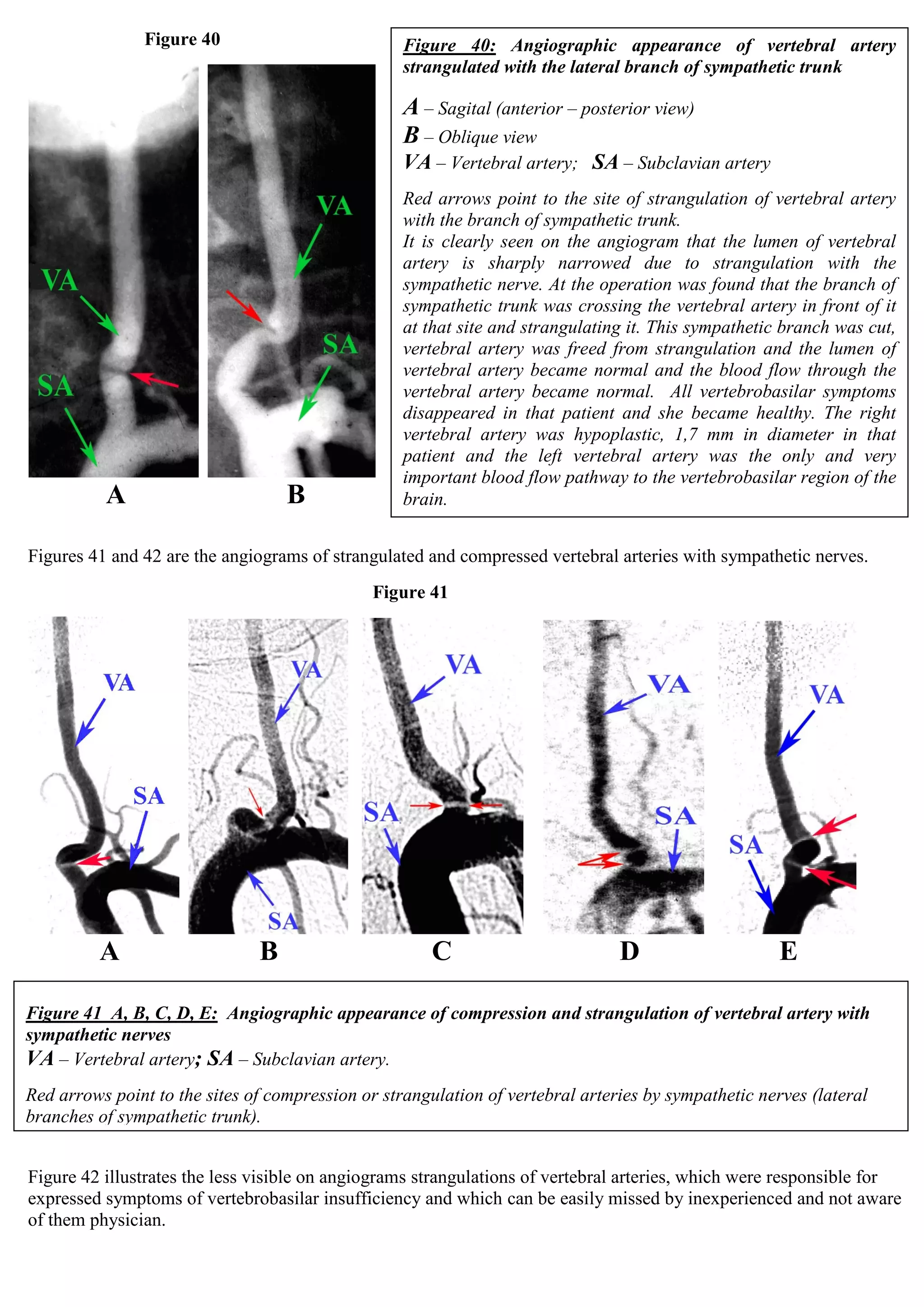 Cerebrovascular Disease, Cerebrovascular Insufficiency, Vertebrobasilar ...