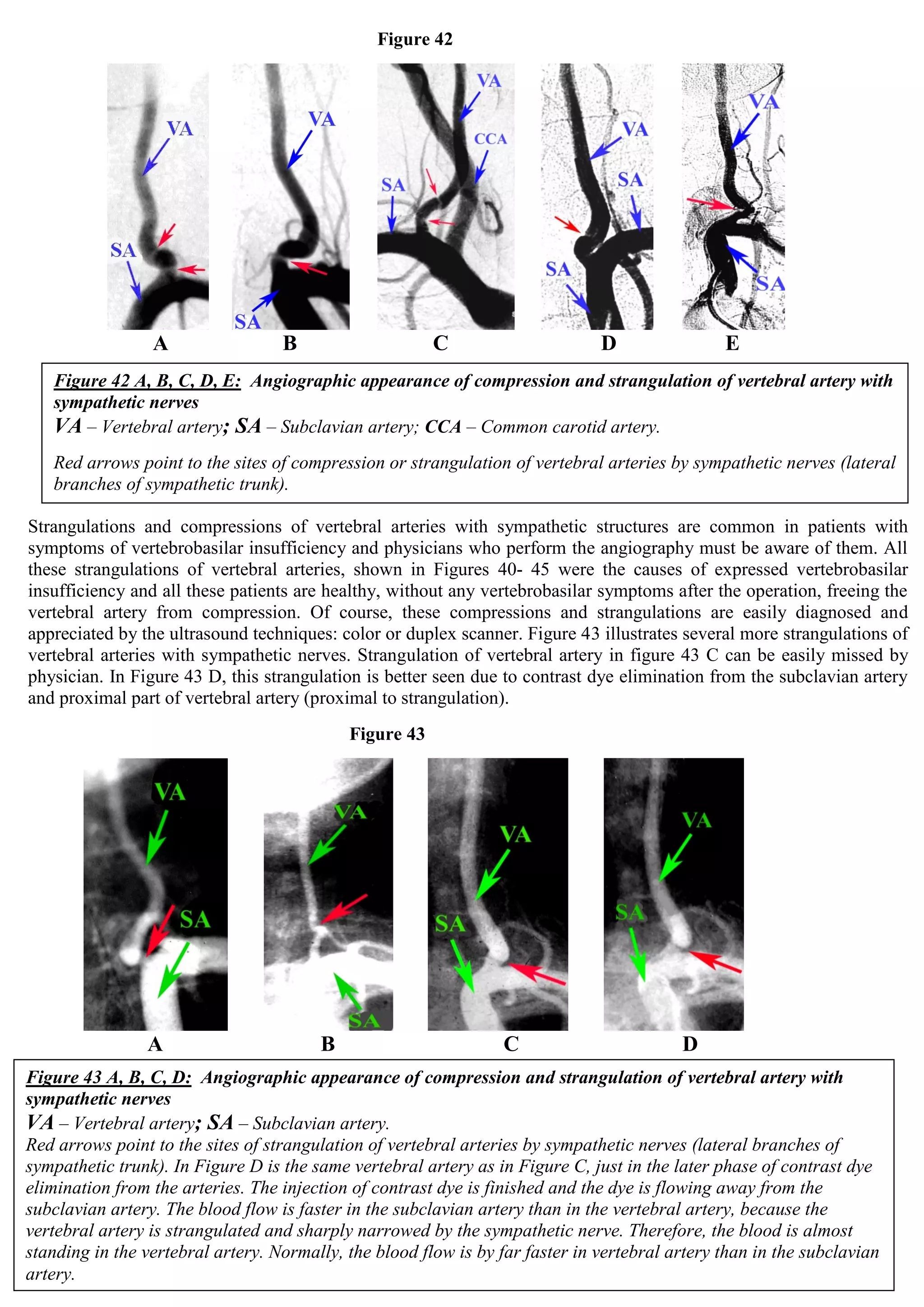 Cerebrovascular Disease, Cerebrovascular Insufficiency, Vertebrobasilar ...