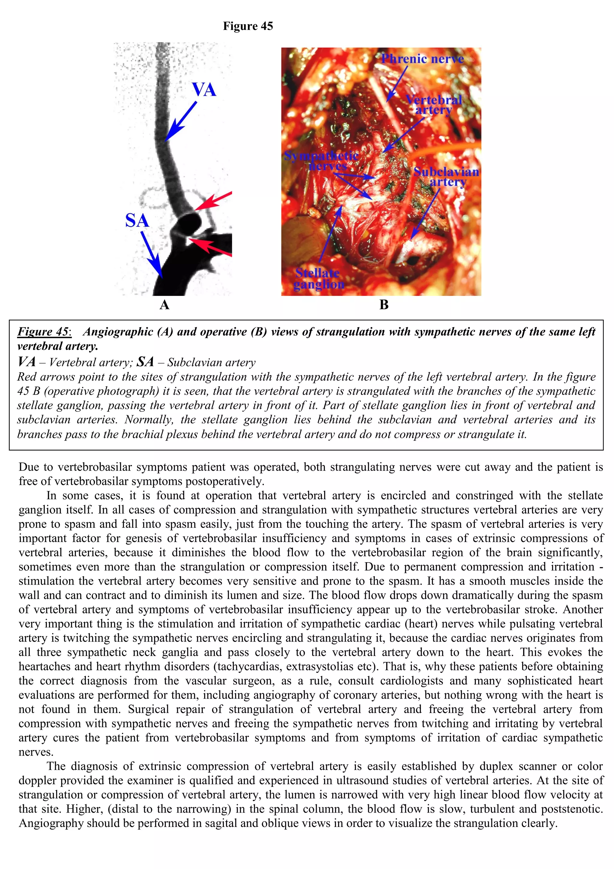 Cerebrovascular Disease, Cerebrovascular Insufficiency, Vertebrobasilar ...