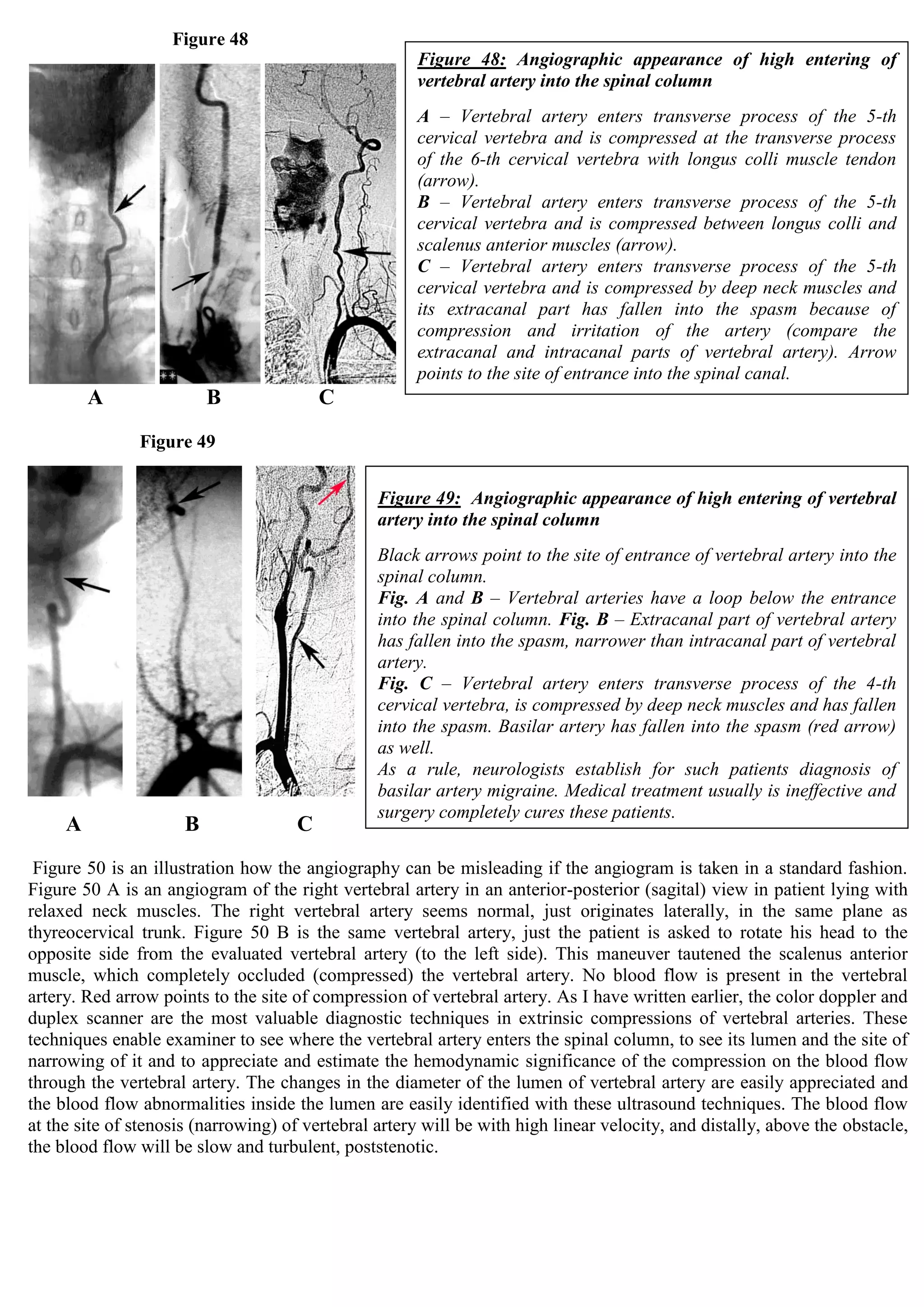 Cerebrovascular Disease, Cerebrovascular Insufficiency, Vertebrobasilar ...