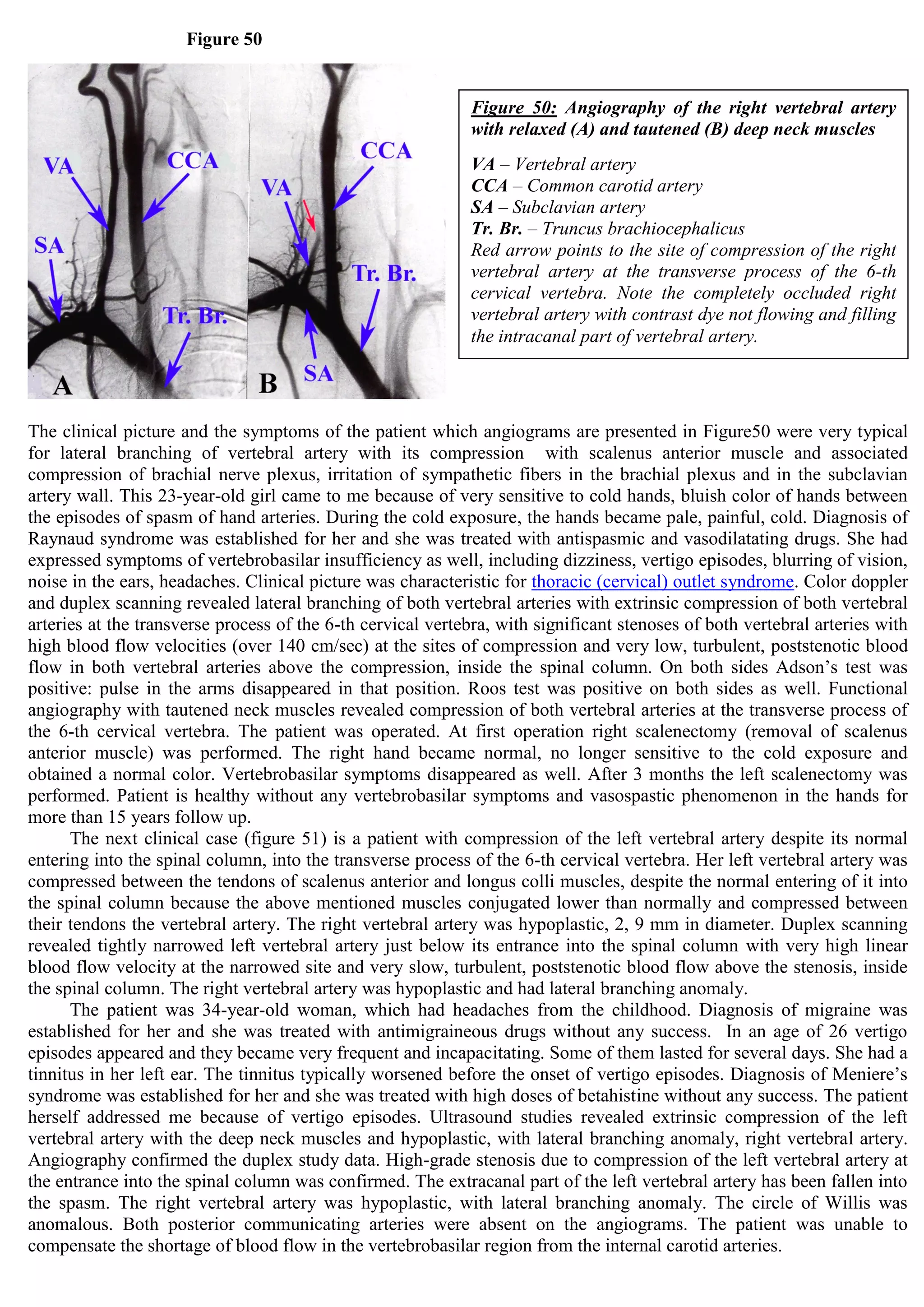Cerebrovascular Disease, Cerebrovascular Insufficiency, Vertebrobasilar ...