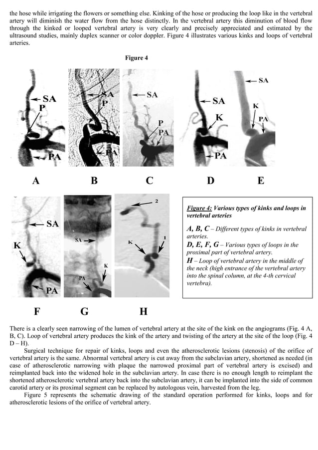 Cerebrovascular Disease, Cerebrovascular Insufficiency, Vertebrobasilar ...
