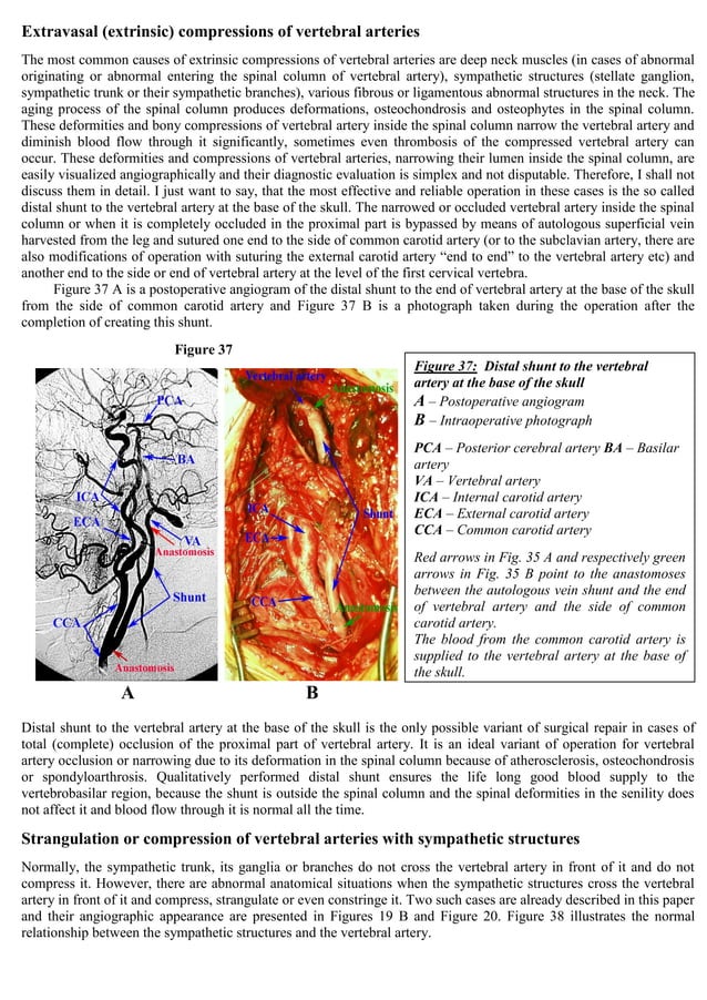 Cerebrovascular Disease, Cerebrovascular Insufficiency, Vertebrobasilar ...