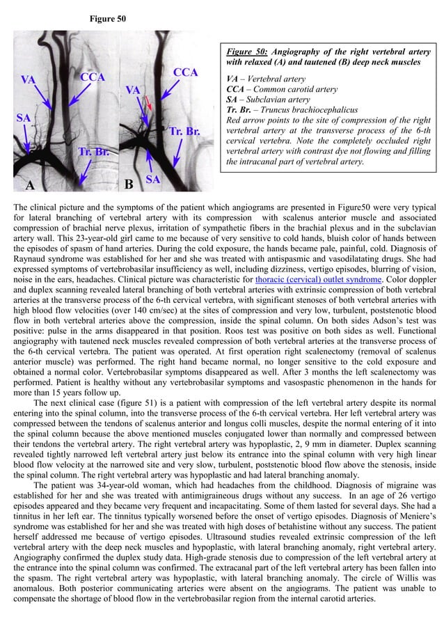 Cerebrovascular Disease, Cerebrovascular Insufficiency, Vertebrobasilar ...