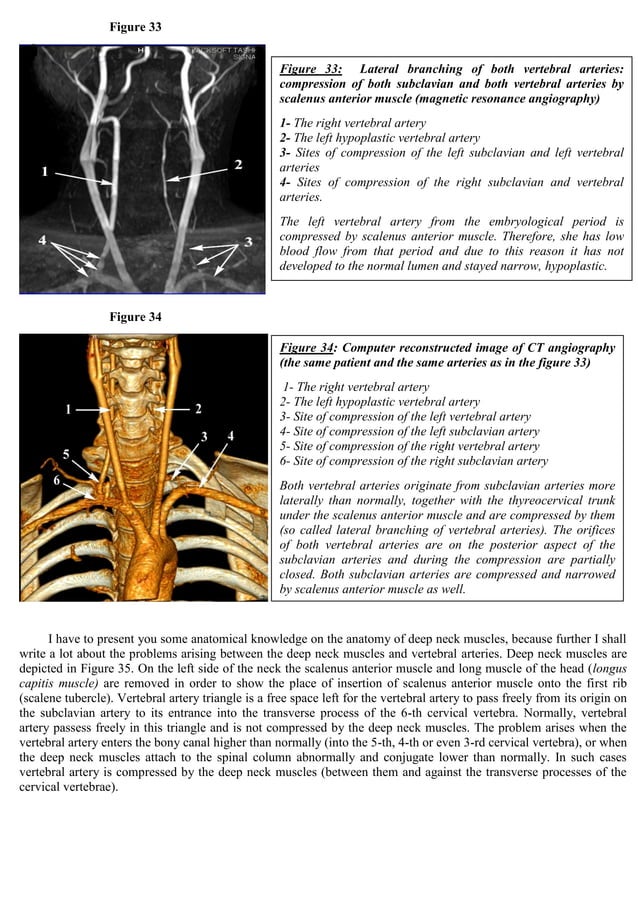 Vertebrobasilar insufficiency: causes, symptoms, and diagnosis ...